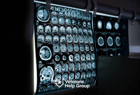 How to Get a 100% VA Disability Rating for TBI (Traumatic Brain Injury)
